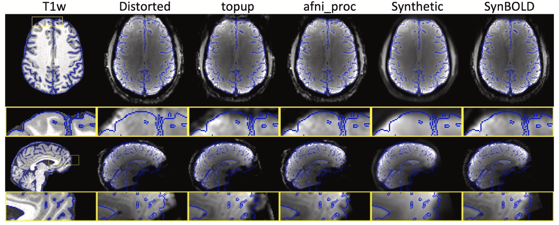 New Method to Correct fMRI Distortions Without the Need for Extra Scans